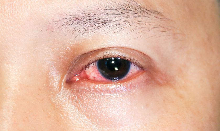 What is the Best Treatment for Eye Infection?